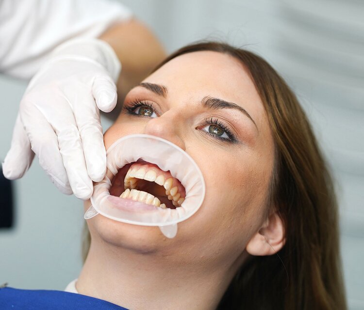 OptraGate 2 | Dental Retractor | Ivoclar AU